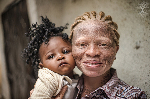 Powerful Photographs of People with Albinism in the Congo - Feature Shoot