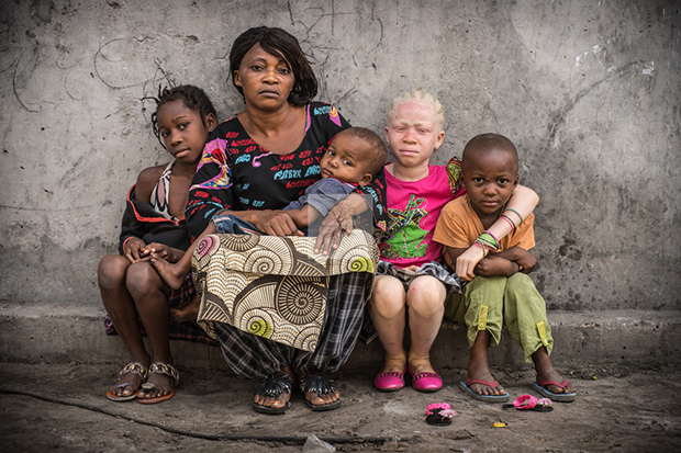 Powerful Photographs of People with Albinism in the Congo - Feature Shoot